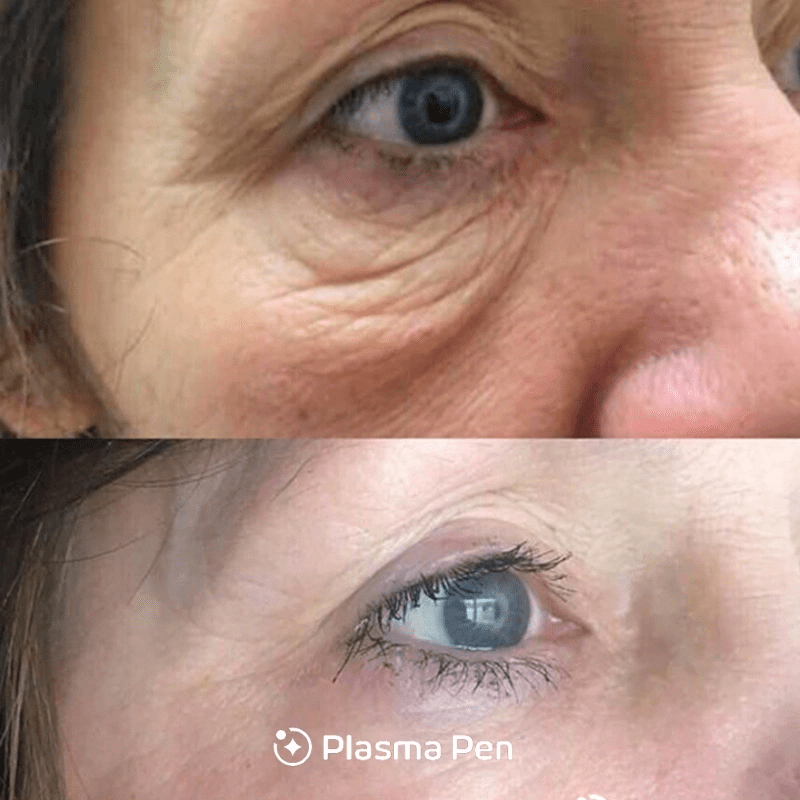 Plasma Pen - Limelight Laser & Medical Spa