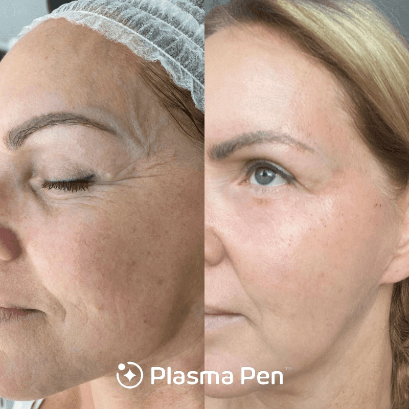 Plasma Pen - Limelight Laser & Medical Spa